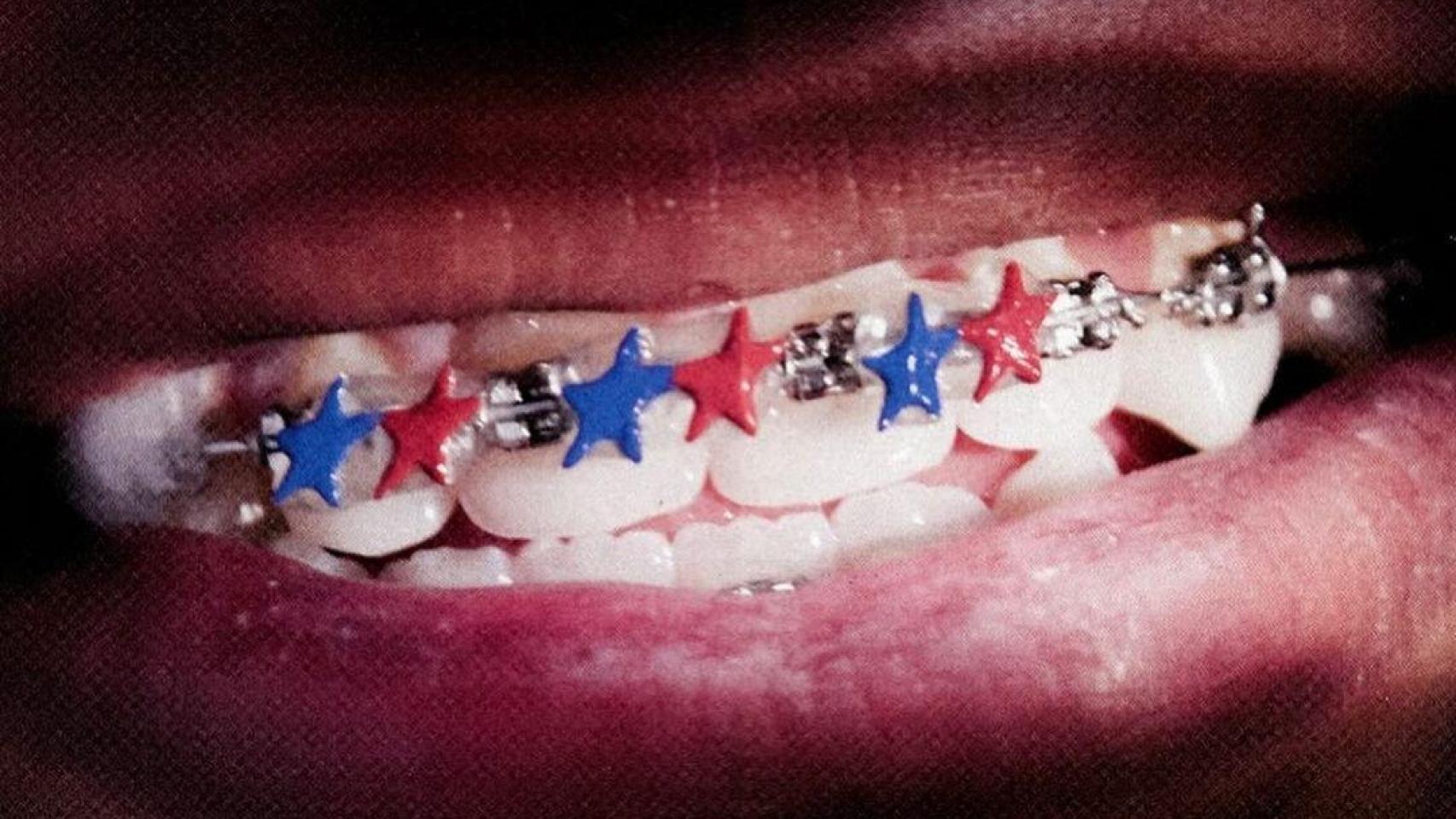 El dentista de Lamine Yamal revela el secreto de sus nuevos brackets ...